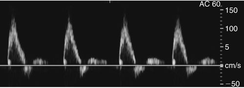 Abdominal Doppler and Color Flow Imaging | Radiology Key