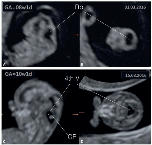 View Fluid Around Baby's Head In Ultrasound Pictures