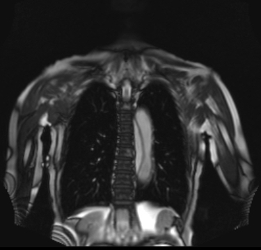 Aortic Dissection (MRI / MRA) - radRounds Radiology Network