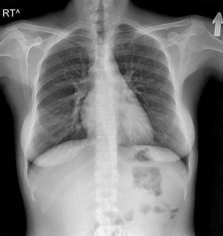 Incidental finding of 11 ribs - radRounds Radiology Network