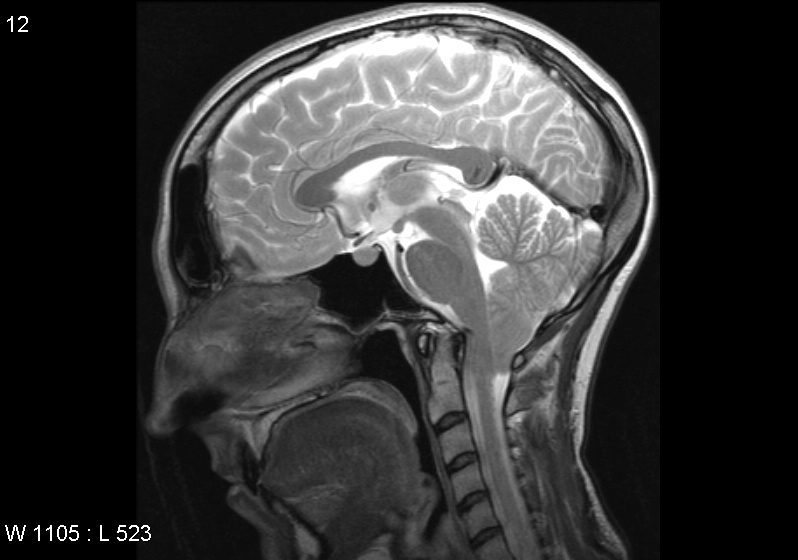 Chiari I Malformation - radRounds Radiology Network