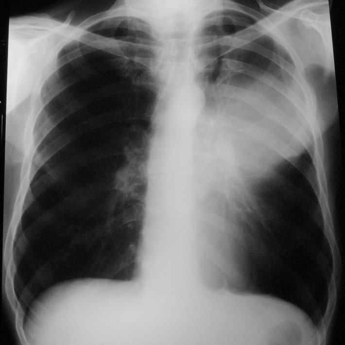 Left Upper Lobe Collapse - CXR - radRounds Radiology Network