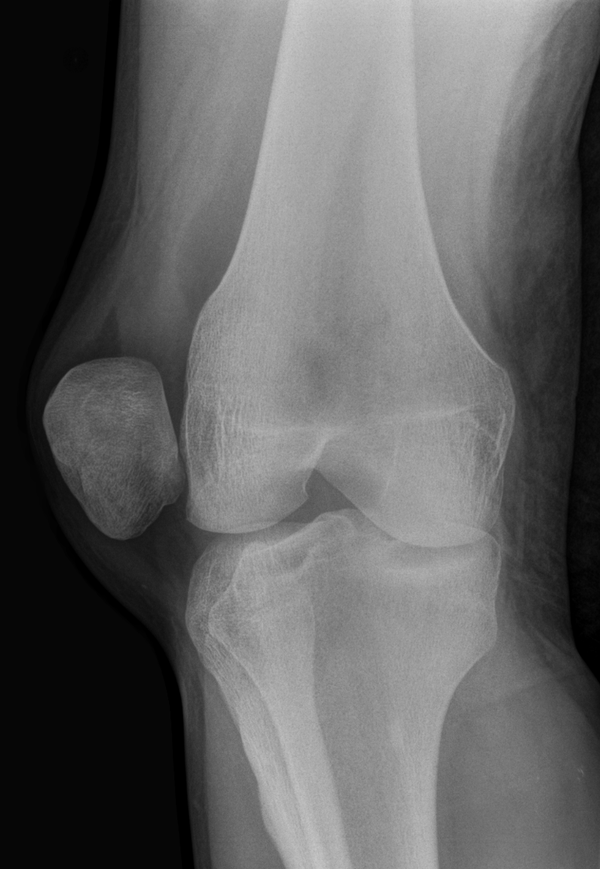 Patellar Dislocation - X-Ray - radRounds Radiology Network