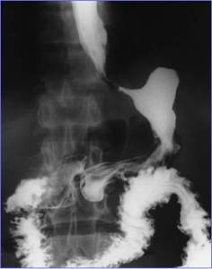 Linitis Plastica - radRounds Radiology Network