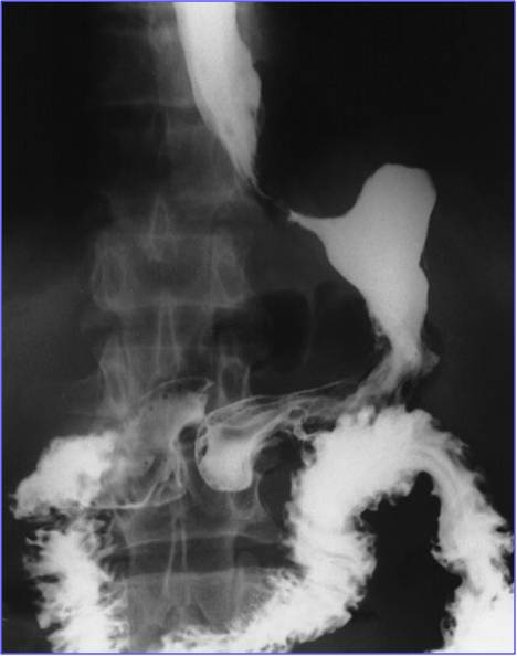 Linitis Plastica - radRounds Radiology Network