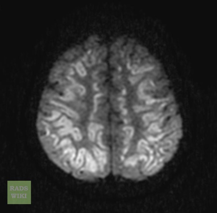 Diffuse hypoxic ischemia (MRI) - radRounds Radiology Network