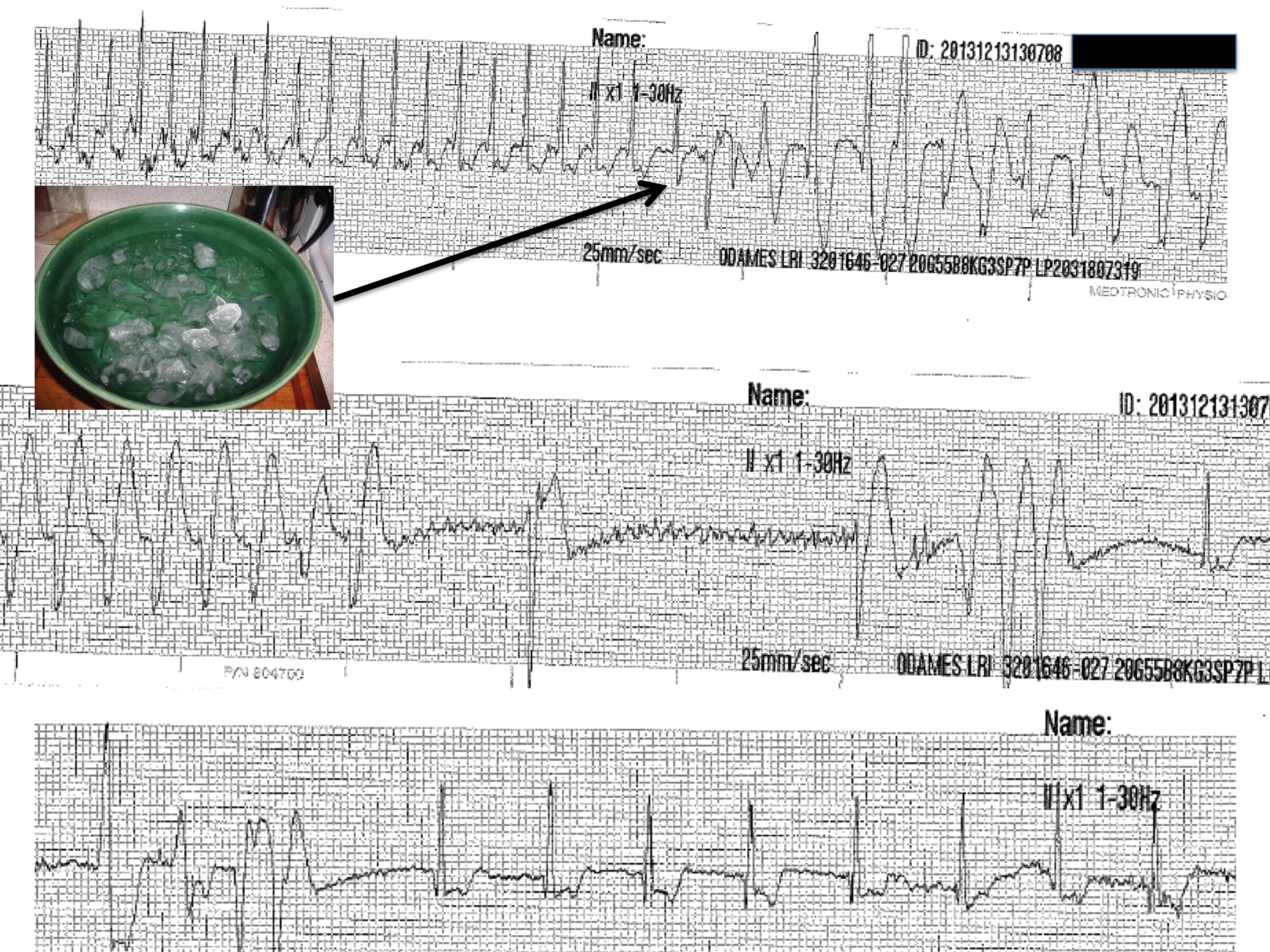 The ice bucket challenge: The best solution to SVT | The Rolobot Rambles