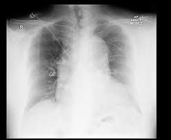 Aortic Dissection – New Jetpack Site