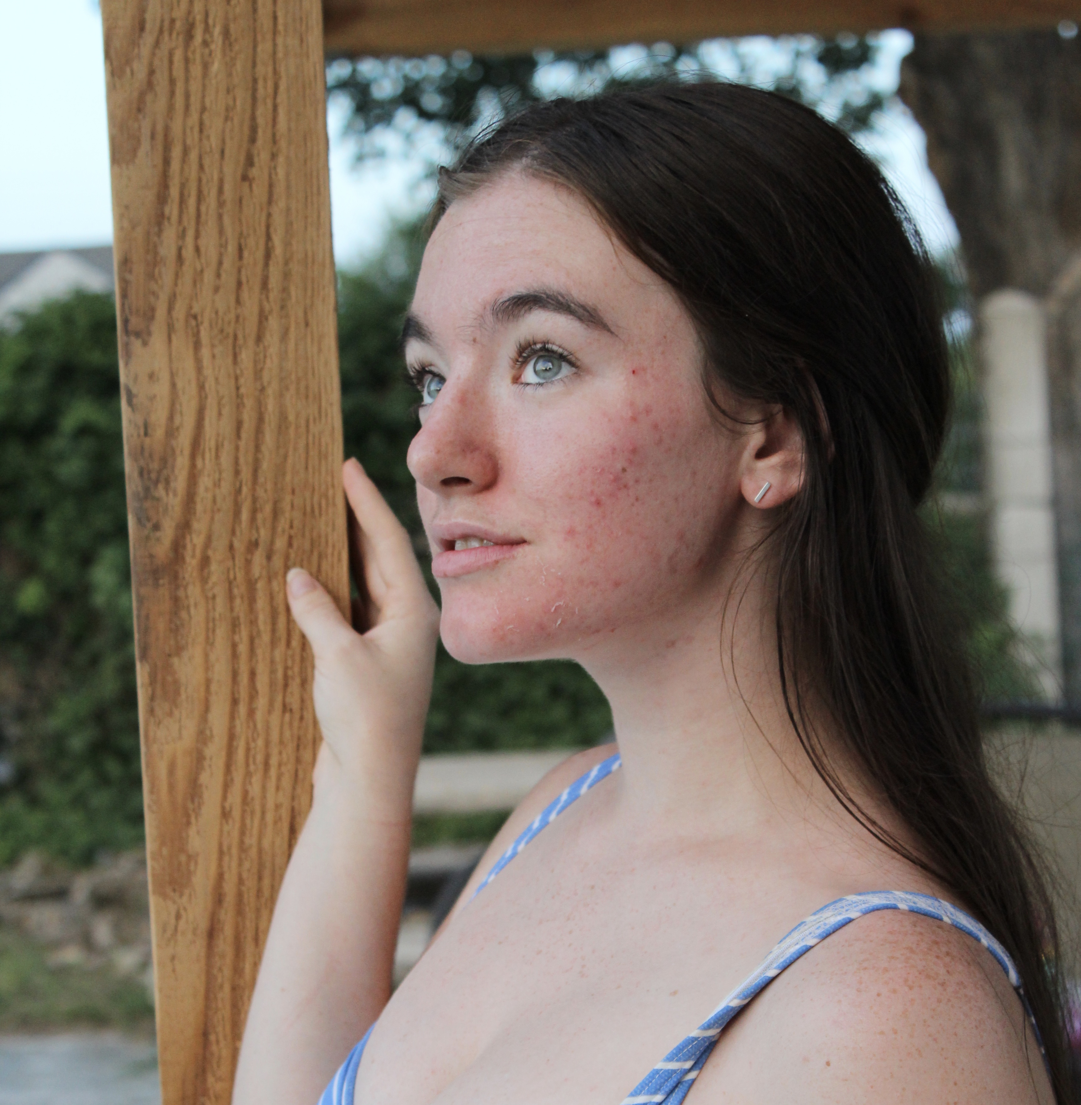 The best skincare tips for people with acne prone skin - Ryality