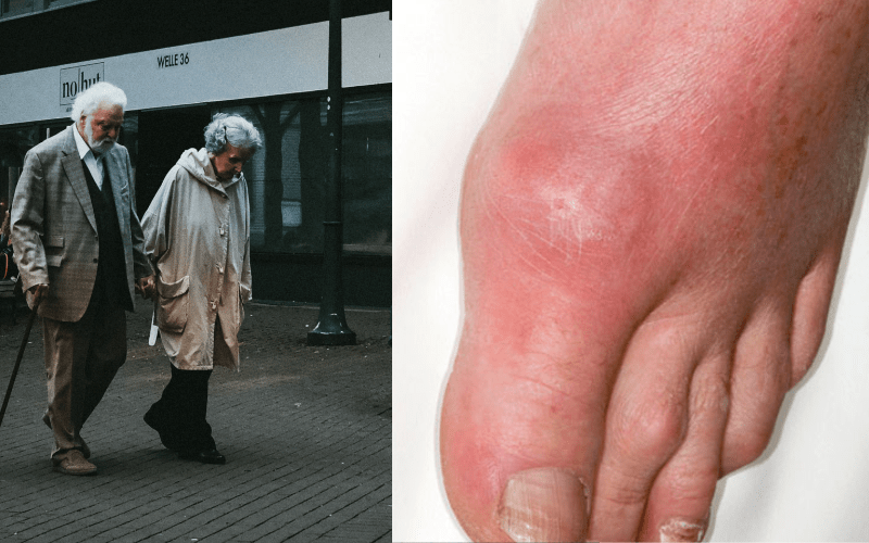 KENAPA GOUT MENYERANG GOLONGAN BERUMUR? KETAHUI PUNCA DAN CARA RAWATAN GOUT