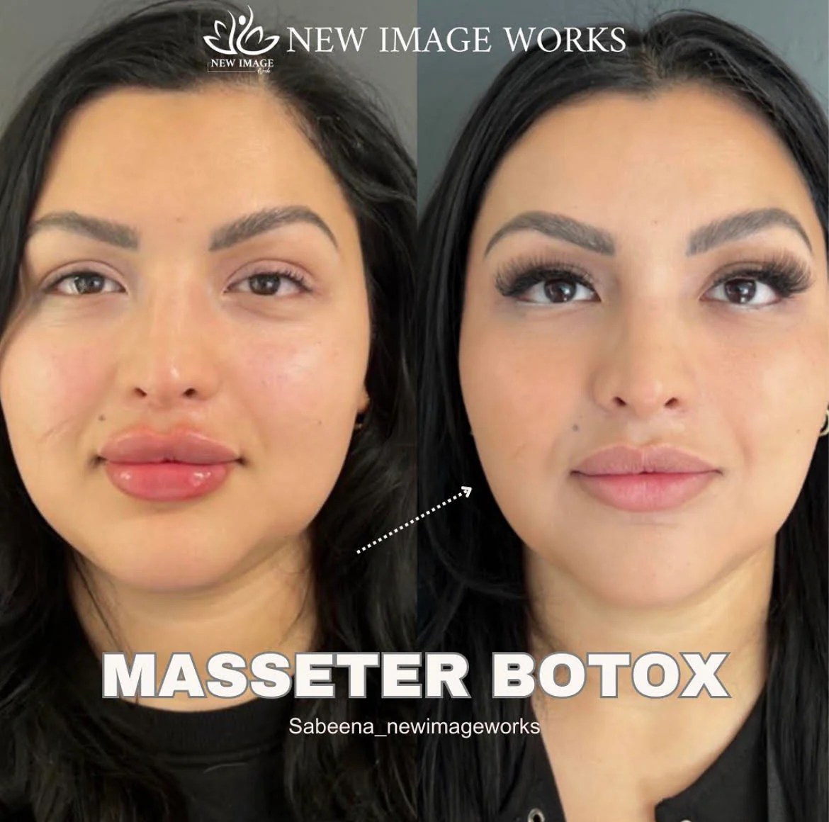 Masseter Botox Transform Your Jawline Masseter Botox Benefits