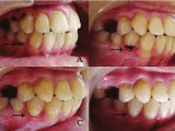 Laser Gingivectomy Sifsof