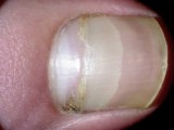 Nail Ridges