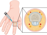 Guide To Local Anaesthetic Skintel