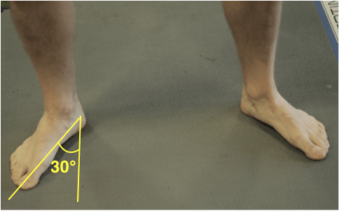 How to Fix Patellar Compressive Syndrome – Squat University