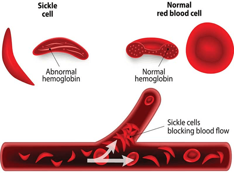 Sickle Cell; An Avoidable Disease? – The Standard Newspaper | Gambia