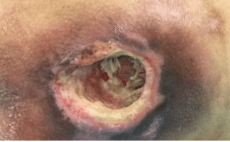 Pressure Injury Hub