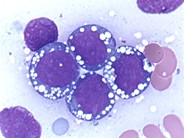 Burkitt Leukemia