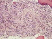 Bone Marrow Fibrosis 1