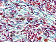 Bone Marrow Fibrosis 5