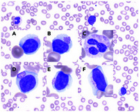 Lymphocytes In Sanfilippo Syndrome Display Characteristic Alder Reilly