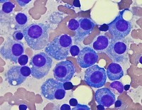 Multiple Myeloma Bone Marrow Smear 2
