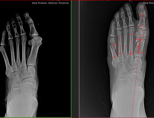 Minimally Invasive Bunion Removal Surgery | The Bunion Cure