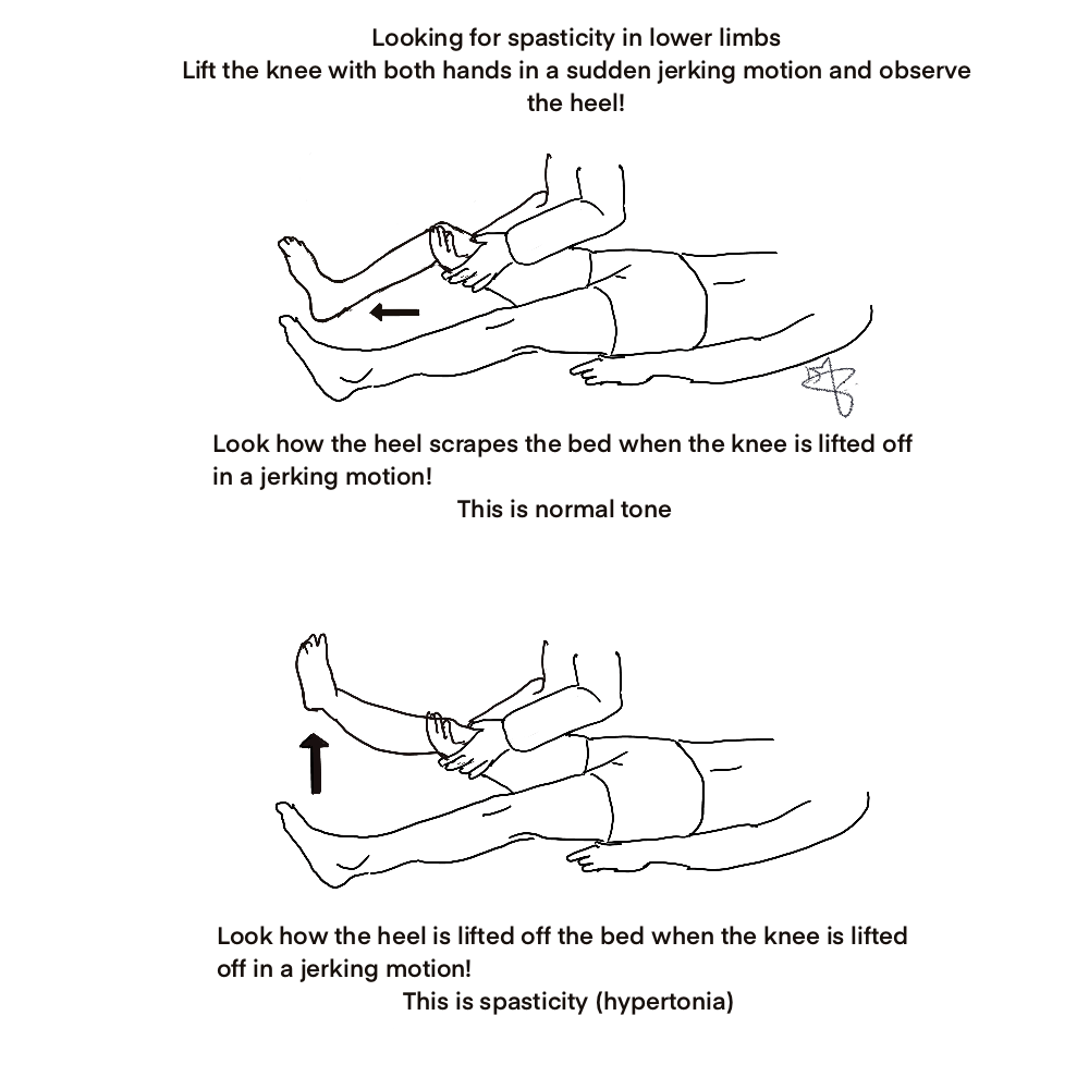 Neurologic Examination of the Limbs - The Med Book