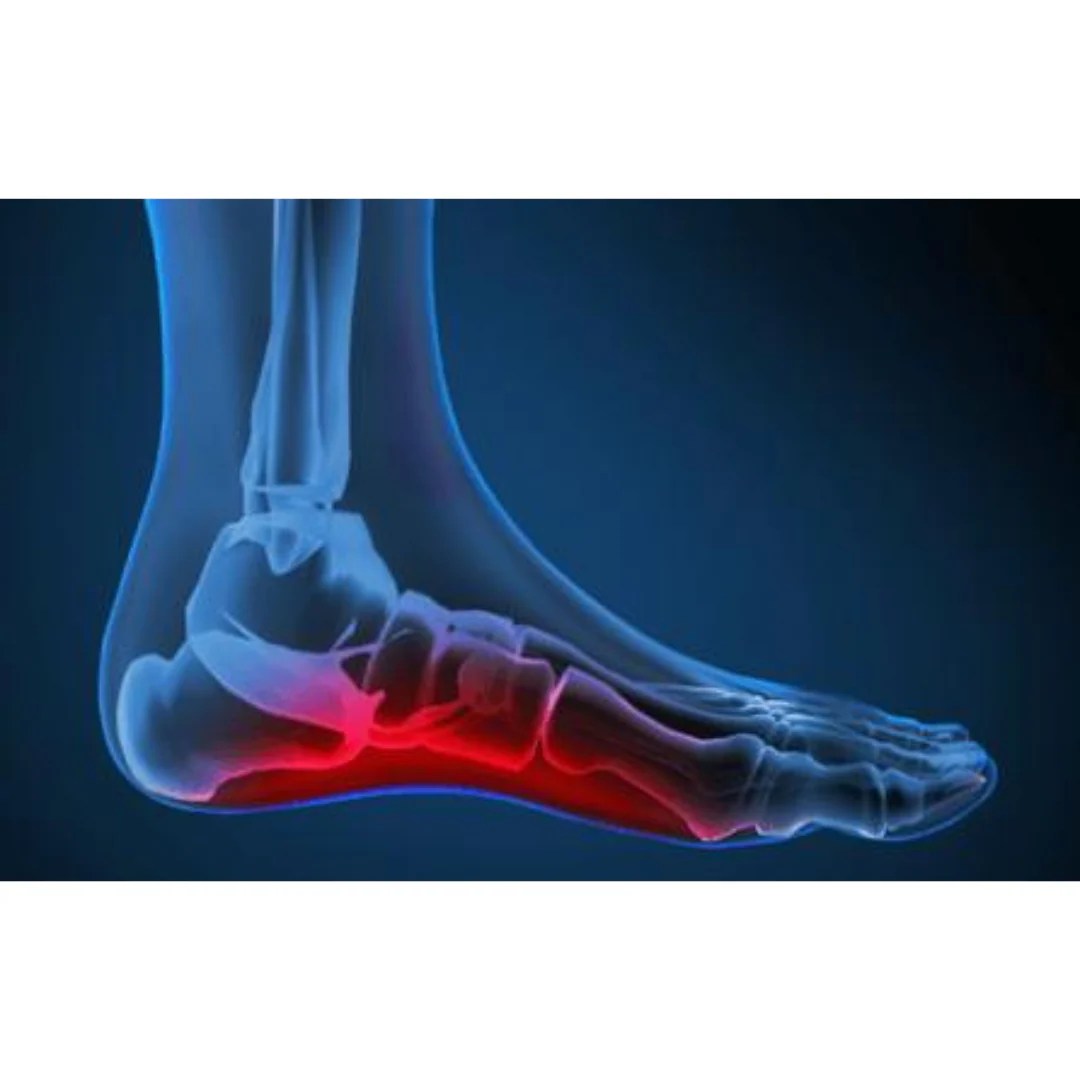 Flat Feet Symptoms Causes And How To Fix Flat Feet Pain Pdepo
