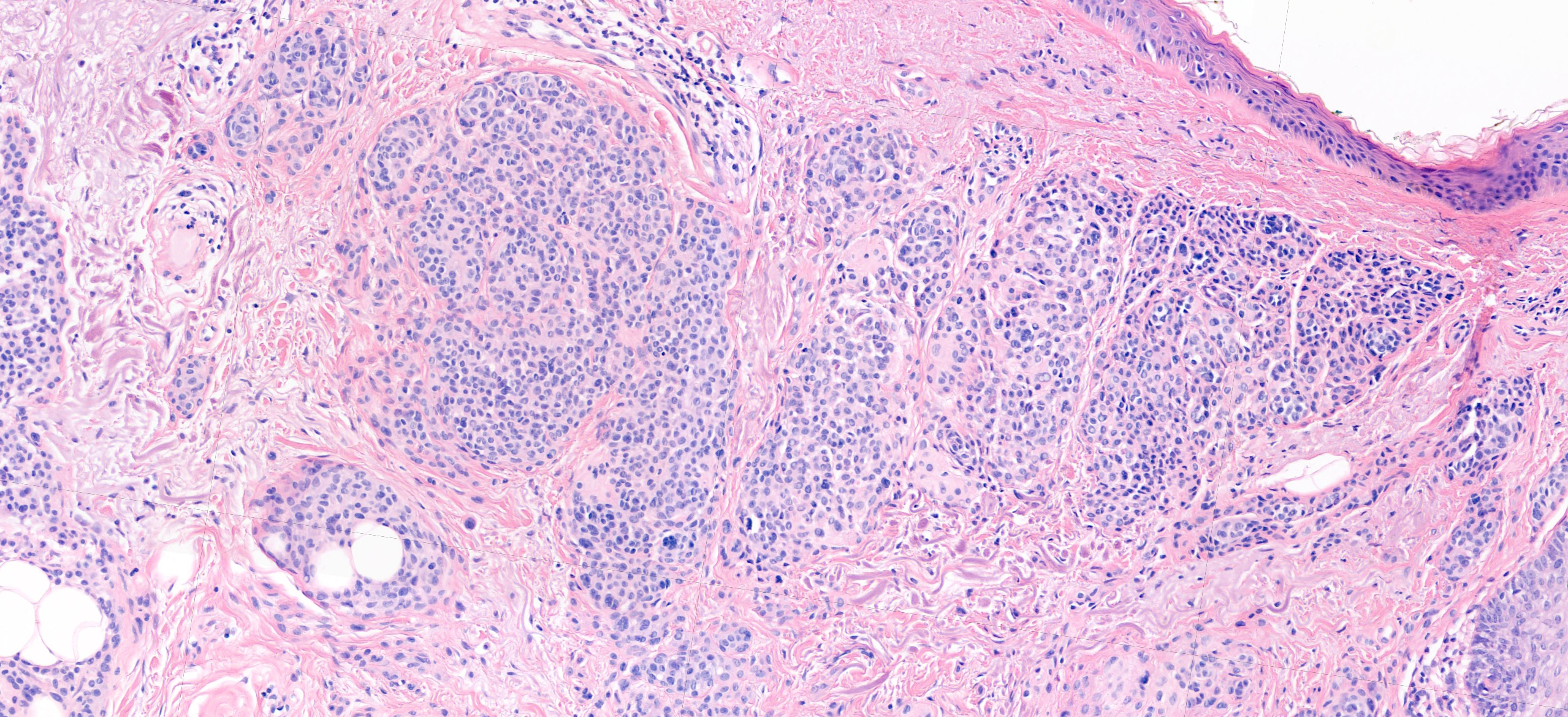 The (in)visibility of human tissue (journey of a dermatological mole ...