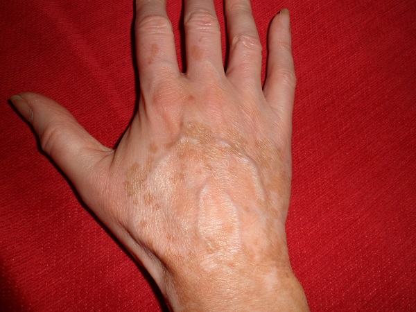 Best vitiligo hair colour - The Vit Pro (A Vitiligo Blog)