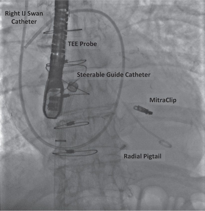 Transradial Approach in Structural Heart Disease | Thoracic Key