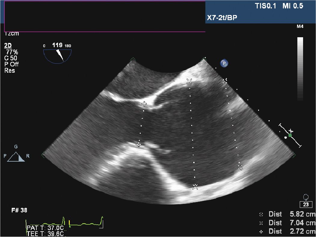 Echocardiographic Evaluation of Aortic Pathology | Thoracic Key