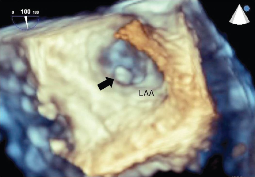 Echocardiography in the Evaluation of Intracardiac Masses | Thoracic Key