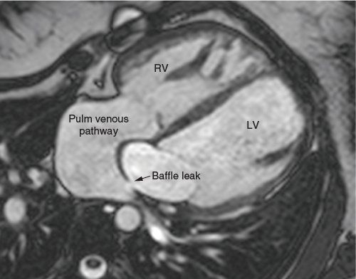d-Transposition of the Great Arteries | Thoracic Key