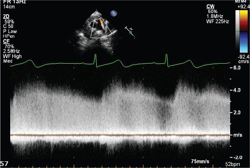 Patent Ductus Arteriosus and Aortopulmonary Window | Thoracic Key