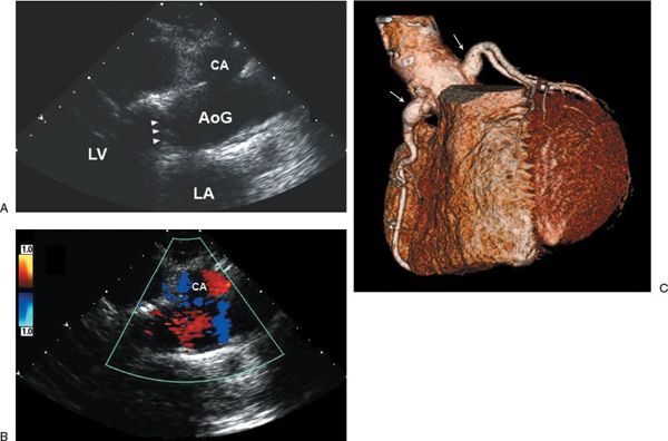Marfan Syndrome: Aortic Aneurysm and Dissection | Thoracic Key