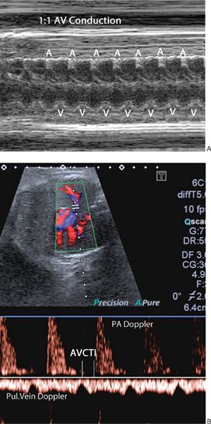 Fetal Echocardiography | Thoracic Key
