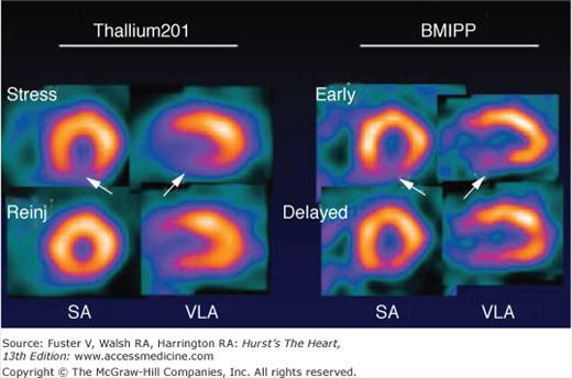 Nuclear Cardiology | Thoracic Key
