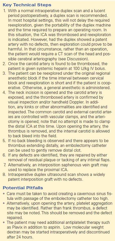 Acute Stroke after CEA | Thoracic Key