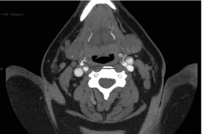 Carotid Artery Dissection | Thoracic Key