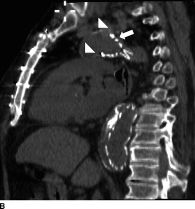 Type A Aortic Dissection after TEVAR | Thoracic Key