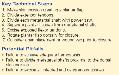 Transmetatarsal Amputation | Thoracic Key