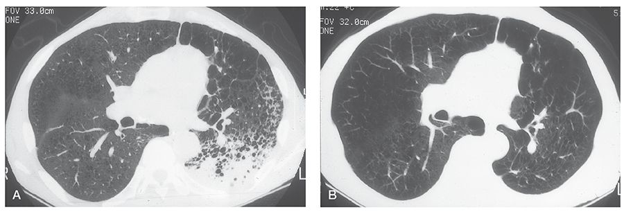 Emphysema and Chronic Obstructive Pulmonary Disease | Thoracic Key