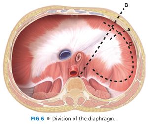 Exposure and Open Surgical Management at the Diaphragm | Thoracic Key