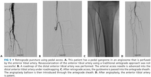 Percutaneous Femoral–Popliteal Reconstruction Techniques: Reentry ...