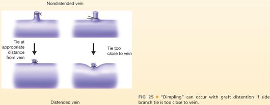 Maximizing Vein Conduit for Autogenous Bypass | Thoracic Key