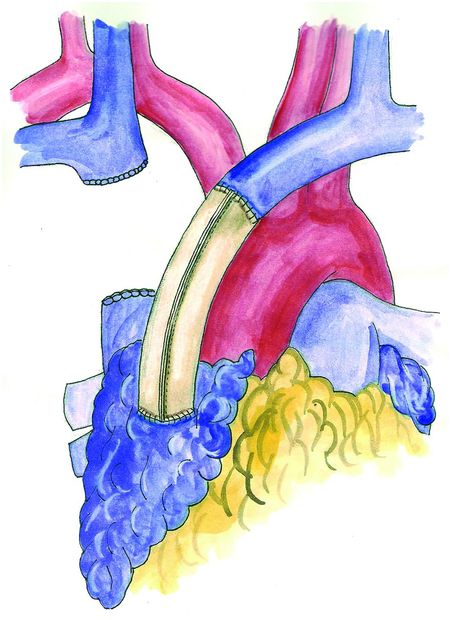 Superior vena cava obstruction | Thoracic Key