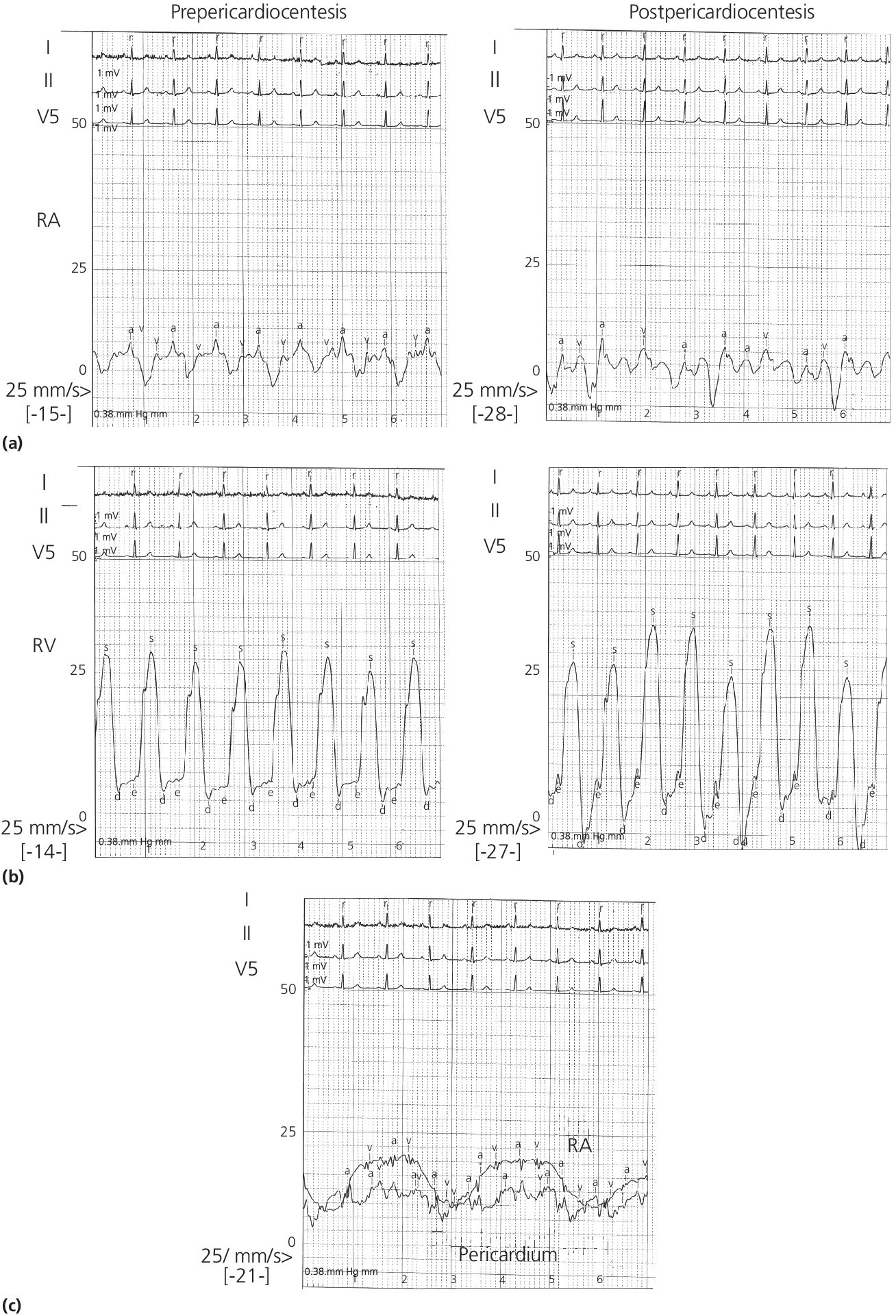 19: Cardiac tamponade | Thoracic Key