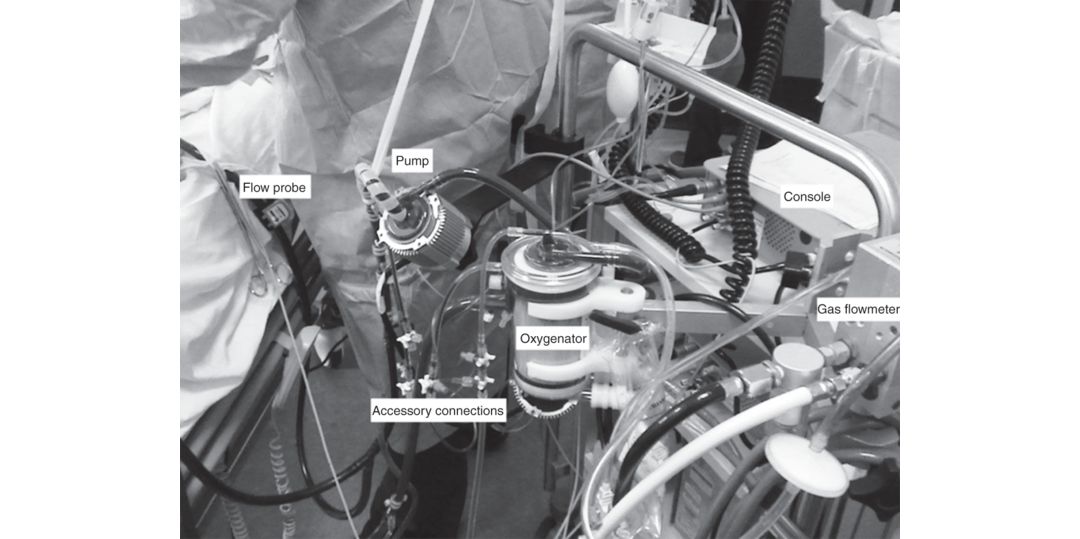 The ECMO circuit | Thoracic Key